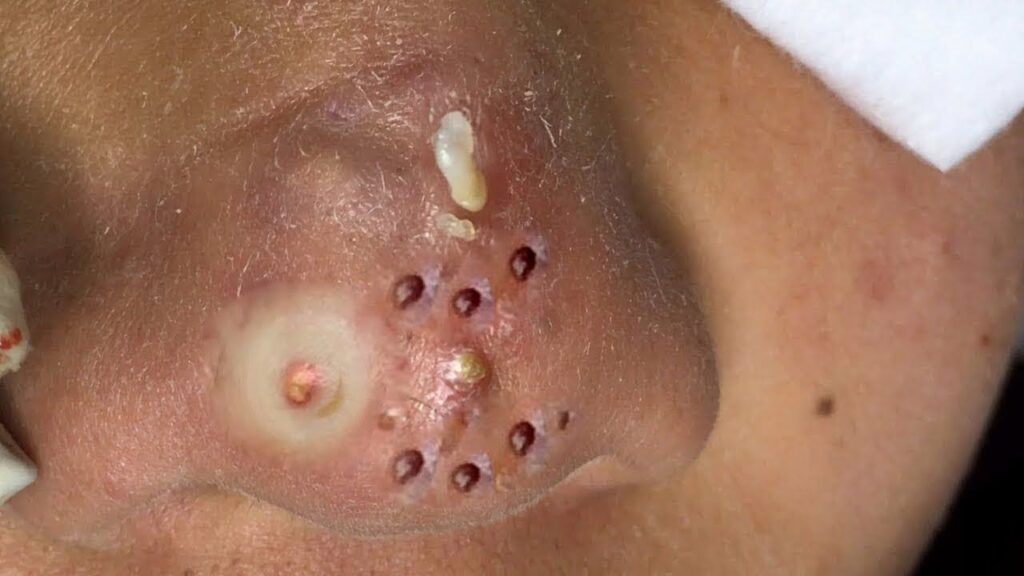 Nose Blackheads Extraction: Everything You Need to Know – Acne Treatment