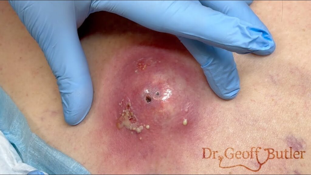 Unclogging the Mysteries: A Deep Dive into Giant Cyst Pops – Acne Treatment