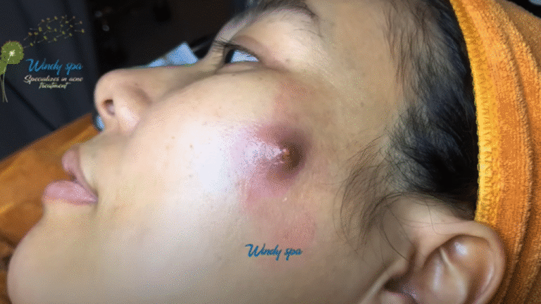 Banish That Bump: Your Guide to Safe Cyst Removal – Acne Treatment