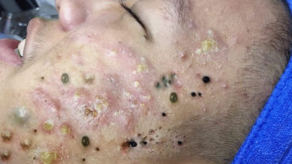 Conquer Your Acne: A Guide to Clear Skin – Acne Treatment